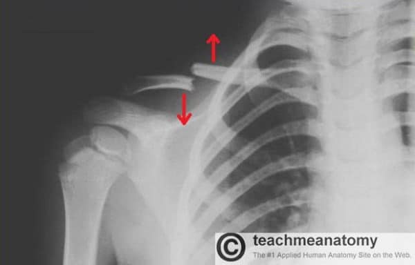 The Clavicle - Functions - Landmarks - Fractures - TeachMeAnatomy