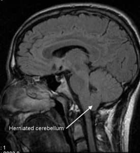 Posterior Cranial Fossa - Boundaries - Contents - TeachMeAnatomy