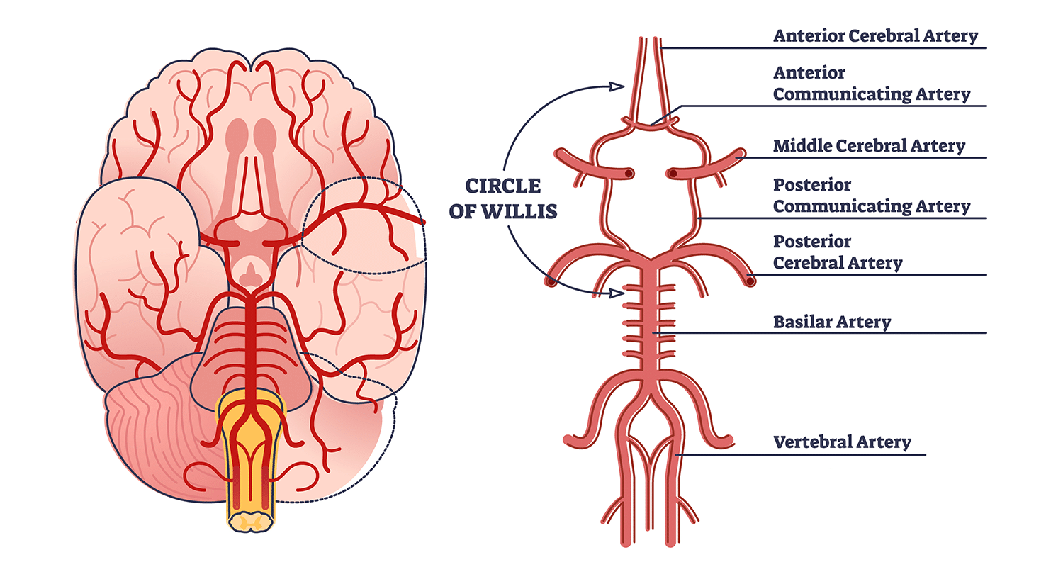 Circle Of Willis De Novo Intracerebral Aneurysm In A Child With