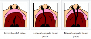 The Palate - Hard Palate - Soft Palate - Uvula - TeachMeAnatomy
