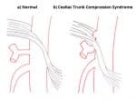 The Coeliac Trunk - Branches - Anastomoses - TeachMeAnatomy