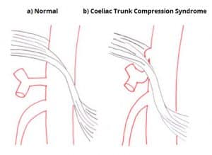 The Coeliac Trunk - Branches - Anastomoses - TeachMeAnatomy