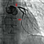 Coronary Arteries and Veins – Anatomy, Distribution, and Clinical ...