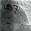 Coronary Arteries and Veins – Anatomy, Distribution, and Clinical ...