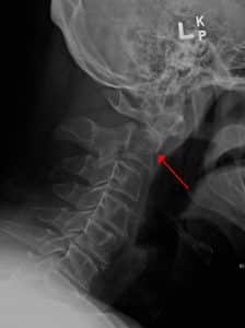 The Cervical Spine - Features - Joints - Ligaments - TeachMeAnatomy