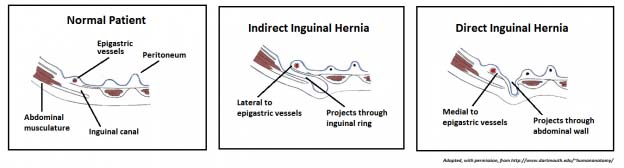 Inguinal (Hesselbach's) Triangle - Borders - Direct Hernia - TeachMeAnatomy