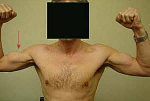 Muscles of the Upper Arm - Biceps - Triceps - TeachMeAnatomy