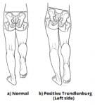 Muscles of the Gluteal Region - Superficial - Deep - TeachMeAnatomy