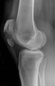 The Patella - Surface Anatomy - Functions - Dislocation - TeachMeAnatomy