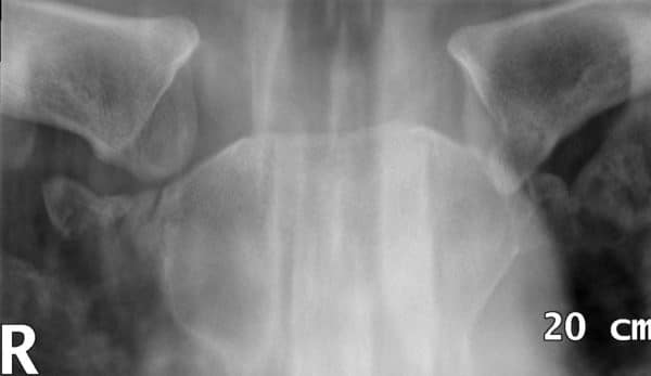 The Sternoclavicular Joint - Structure - Movement - TeachMeAnatomy