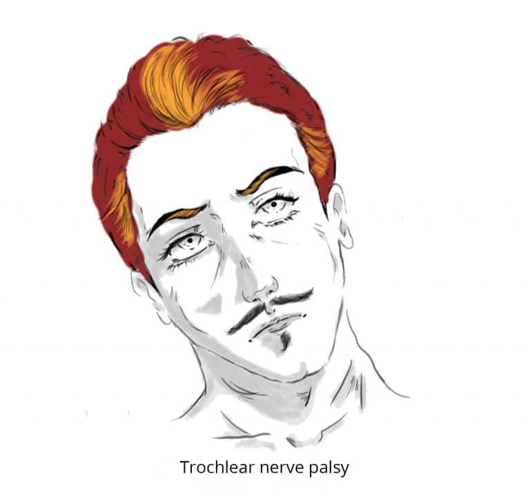 The Trochlear Nerve (CN IV) - Course - Motor - TeachMeAnatomy