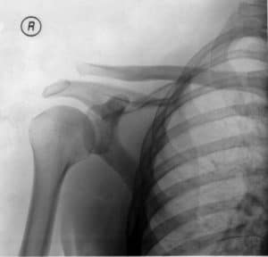 The Acromioclavicular Joint - Structure - Movement - TeachMeAnatomy