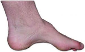 The Arches of the Foot - Longitudinal - Transverse - TeachMeAnatomy